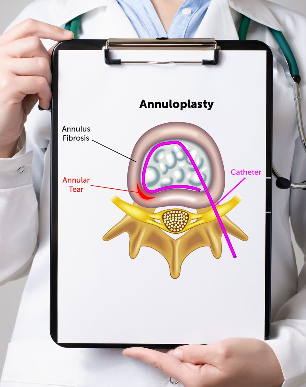 Annuloplasty – Spine One | Denver Spine Pain Specialists